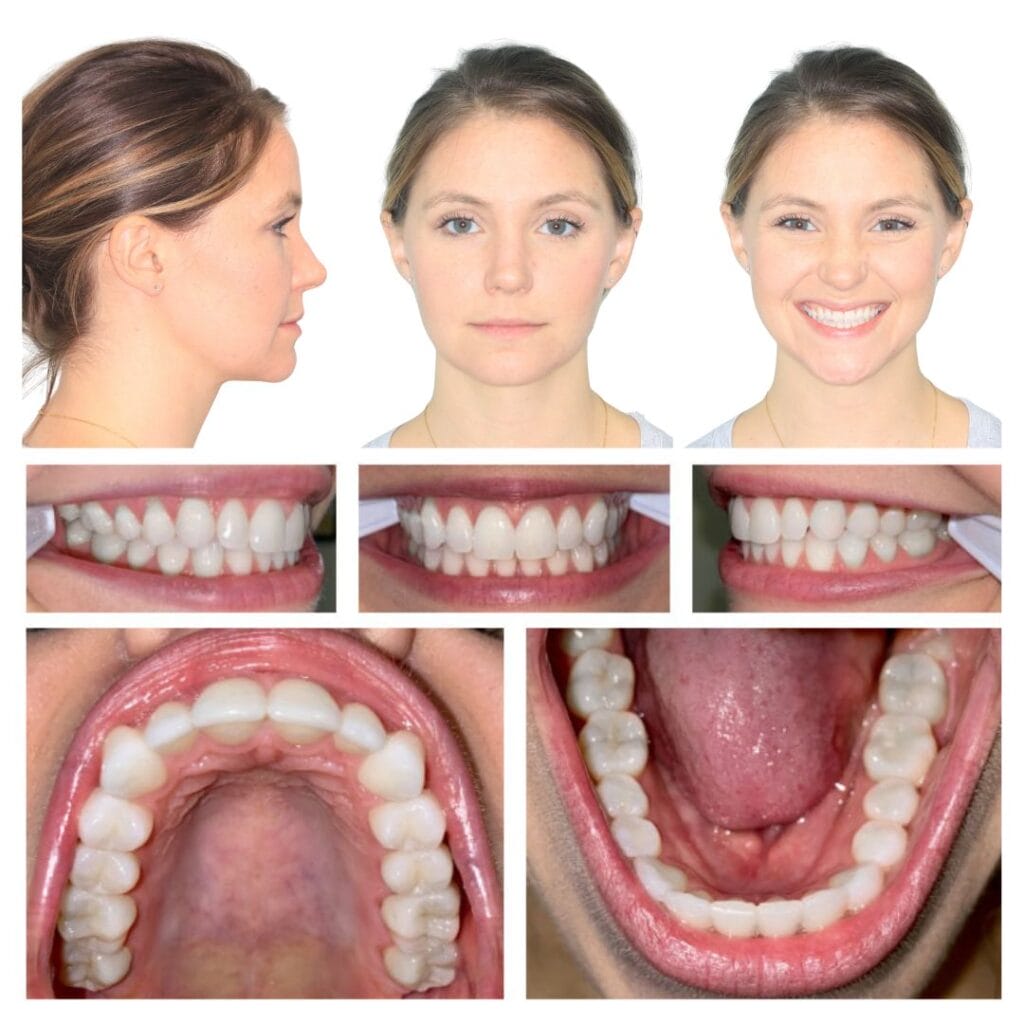 Virtual Smile Assessment - Bates Family Orthodontics