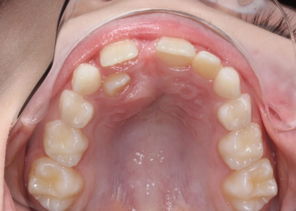 Early Treatment - Bates Family Orthodontics