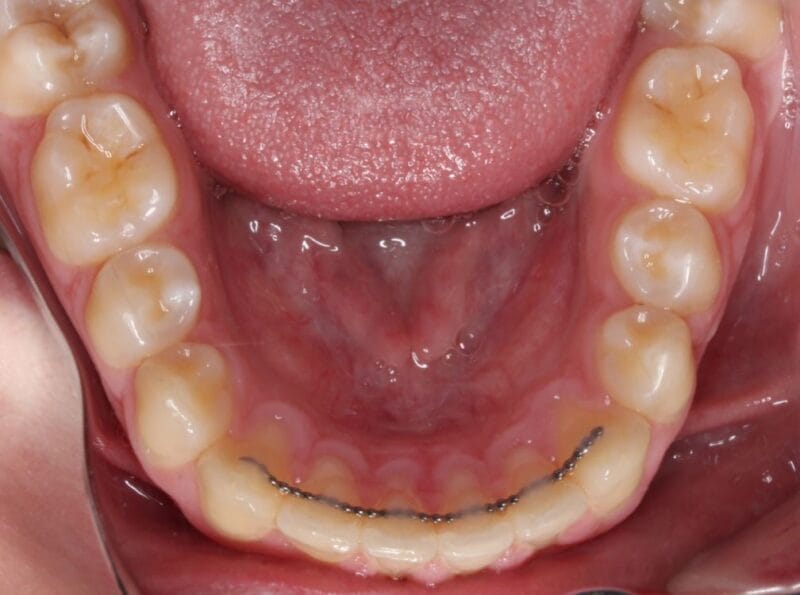 The Pros and Cons of “Permanent” Retainers - Bates Family Orthodontics