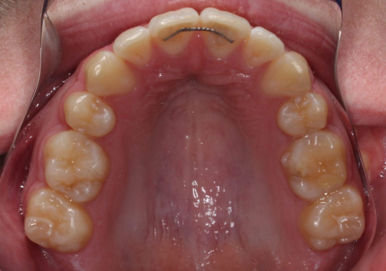 The Pros and Cons of “Permanent” Retainers - Bates Family Orthodontics