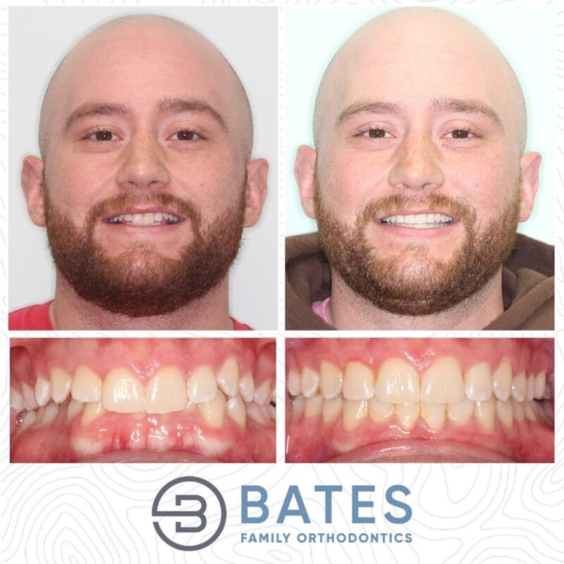 Invisalign in Lynchburg, Virginia - Bates Family Orthodontics
